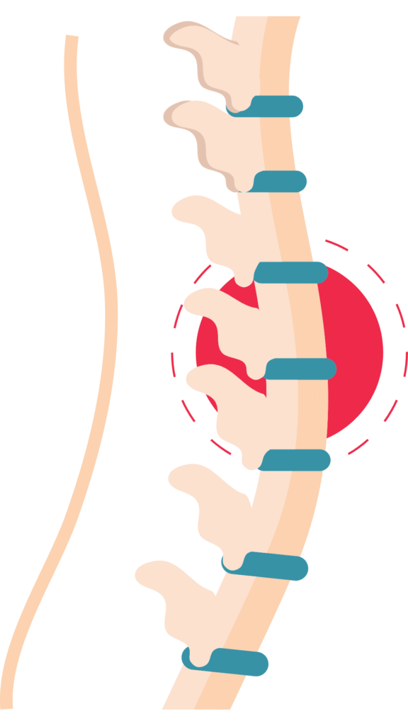 Slipped (Herniated) Disc: What is it and can chiropractic help ...